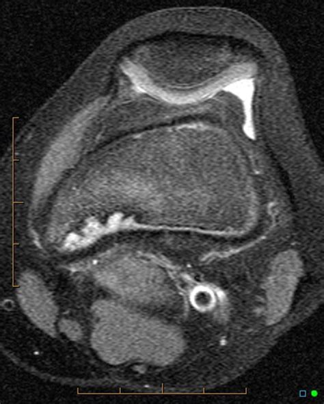 Tumeurs Os Fibrome Non Ossifiant Pinkybone