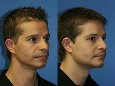 Plastic Surgery Before And After Chin
