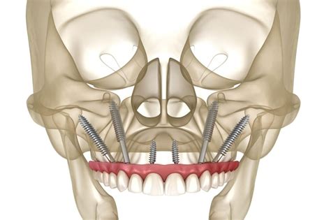 Zygomatic Implants Dental