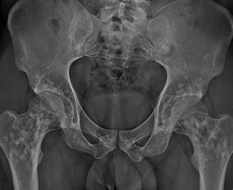 Melorheostosis And Osteopoikilosis Applied Radiology