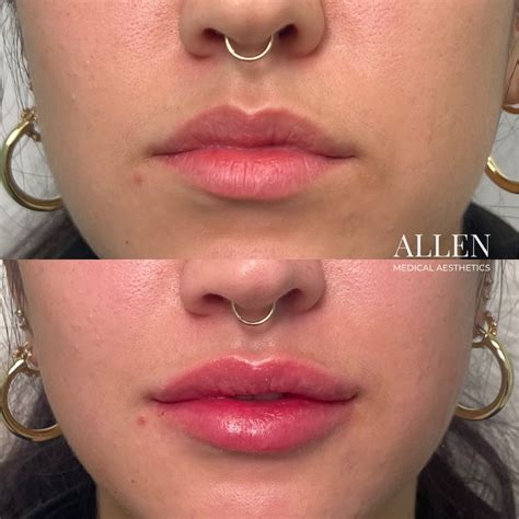 Lip Filler In Seattle Tacoma Allen Medical Aesthetics