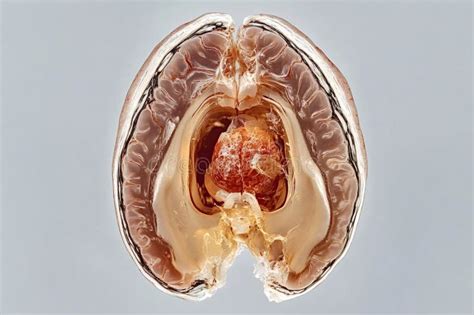 Preserved Human Brain Showing Internal Structures And Cerebellum Stock