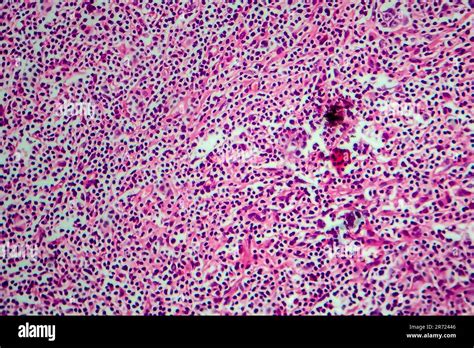 Hodgkins Lymphoma Light Micrograph Photo Under Microscope Stock