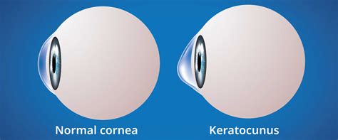 Keratoconus Treatment • Murata Eyecare Optometry Simi Valley