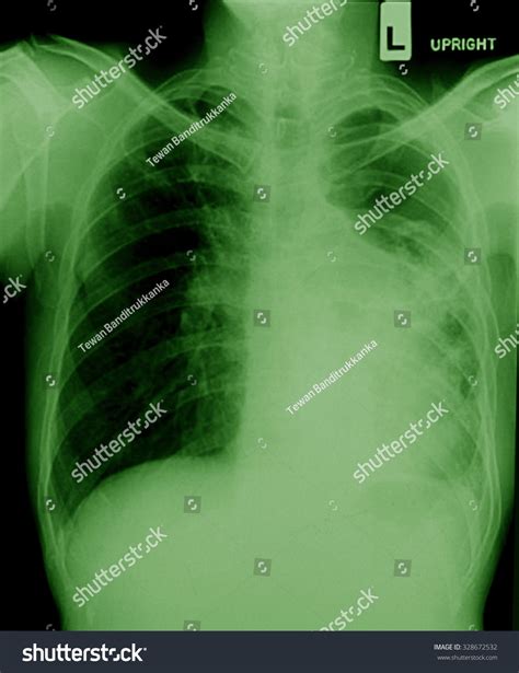 Film Chest Xray Pa Upright Show 스톡 사진 328672532 Shutterstock