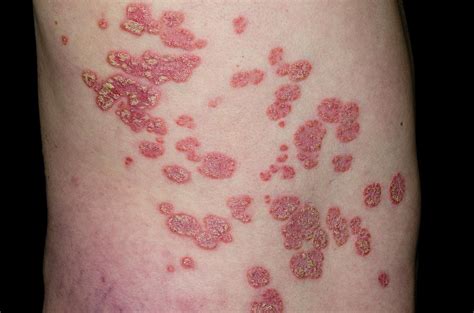 Plaque Psoriasis Tattoos