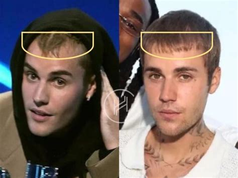 Justin Bieber Hair Transplant Hair Loss And Technical Analysis