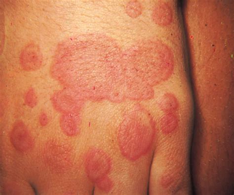 Study Medical Photos Introduction To Erythema Multiforme