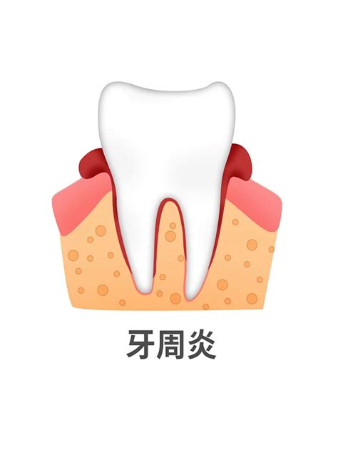 牙周炎 花瓣网