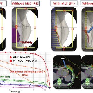 RTOG 0415 And Restrictive Dose Constraints Download Table