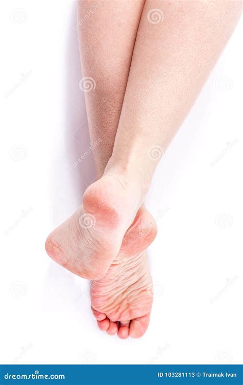 Female Legs With Overdried Dehydrated Dry Skin On Heels Closeup Stock