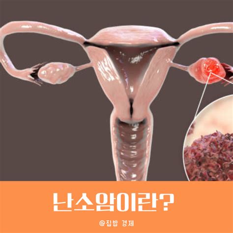 난소암 초기 증상 및 원인 검사 수술 그리고 좋은 음식 네이버 블로그
