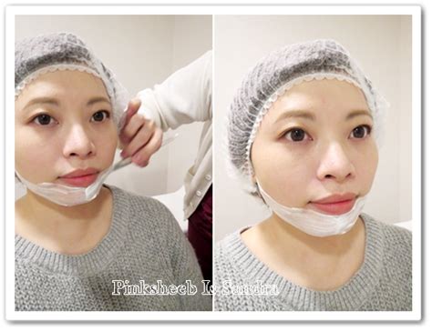 Sandra分享 Restylane 透明質酸豐下巴 Reface Clinic 香港微整形中心