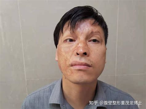 董茂龙科普：瘢痕（疤痕）的诊断 知乎
