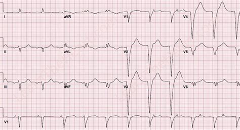 Idioventricular Rhythm Vs Junctional