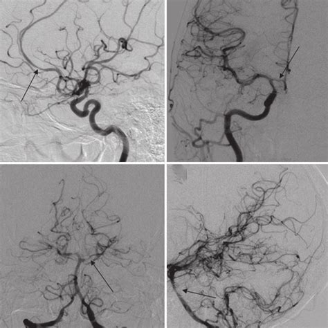 Digital Subtraction Angiography Digital Subtraction Angiography