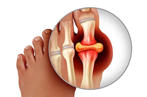 How To Remove Uric Acid Crystallization From Your Body And Prevent Gout