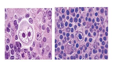 Hodgkins Lymphoma Pptpptx