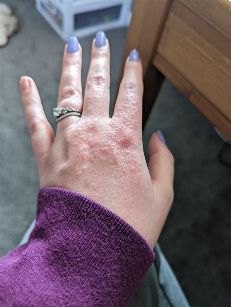 Are There Any Eczema Safe Hand Soaps Or Ways To Wash Hands Reczema