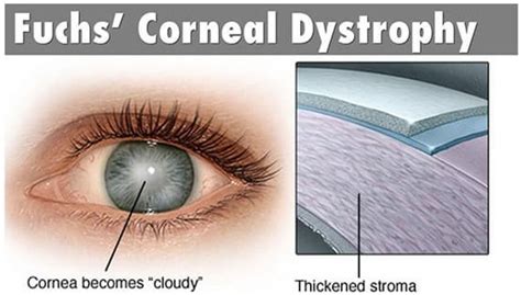 Fuchs Corneal Dystrophy Dr Ramesh Murthy