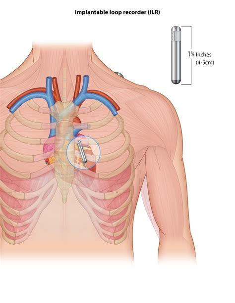 Loop Implant Explant Melbourne Heart Group