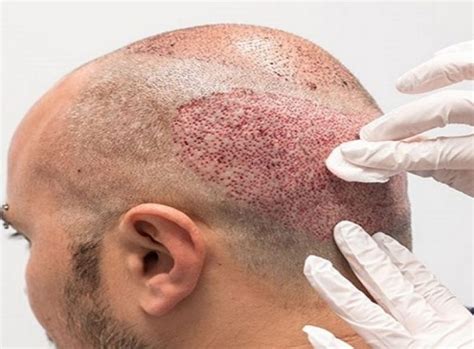 بایدها و نبایدهای بوتاکس کلینیک پوست، مو و زیبایی ایرسا
