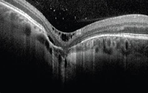 Torpedo Maculopathy Retina Today