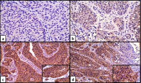 tissue microarray cores stained with pkm2 x40 a low grade