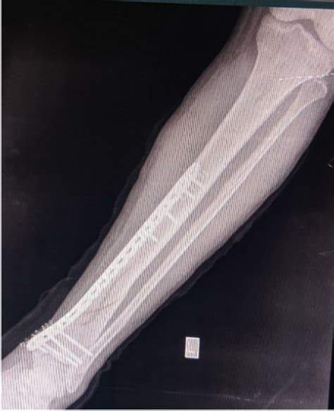 Minimally Invasive Surgery For Fractures When Less Is More Dr