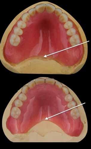 Why Does My Upper Denture Make Me Gag