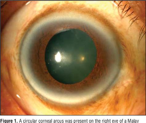 Corneal Arcus