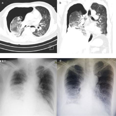 A B Coronal And Axial Slices Of Thorax CT Scan On April 22 Showed
