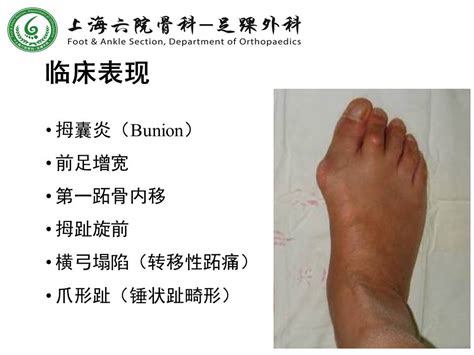 得了拇外翻怎么办？ 标件库