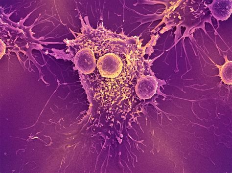 How Is Immunotherapy Used To Treat Bladder Cancer Dana Farber Cancer