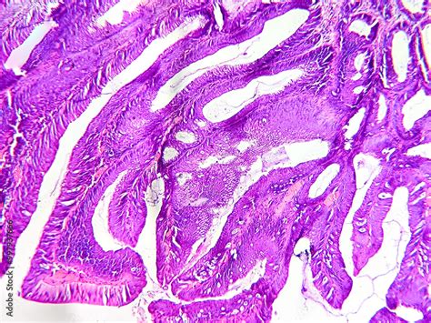 Histological Analysis Of Gastric Polyp Showing Villous Adenoma With