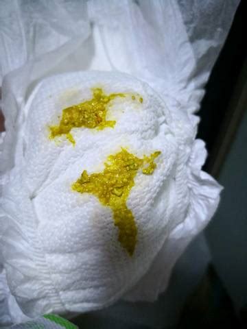 大便带粘液 痢疾样 第2页 大山谷图库
