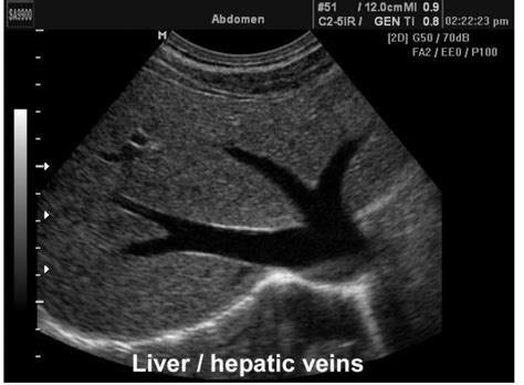Solved Describe The Sonographic Appearance Of This Image