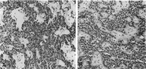 A And 2b Photomicrograph Of The Pancreatic Endocrine Tumors A Left