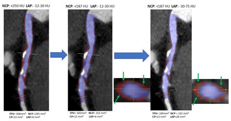 Quantitative Coronary Plaque Analysis By Coronary Computed Tomography