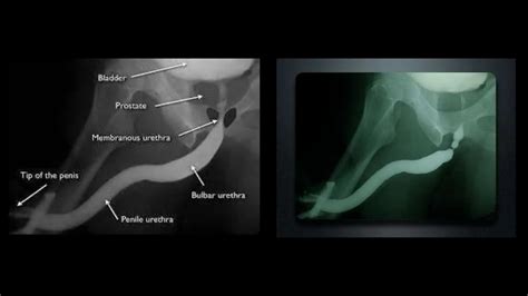 Radiological Procedure Of Retrograde Urethrography Pptx