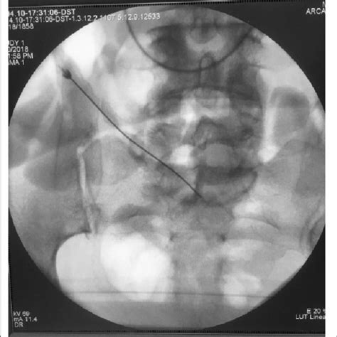 The Anterior Branch Of The Inferior Hypogastric Plexus Download Scientific Diagram