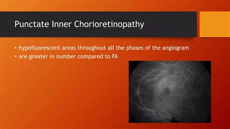 Indocyanine Green Angiography Pptx
