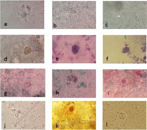 D Fragilis Trophozoite Irregular And Rounded Forms In Wet Mount A