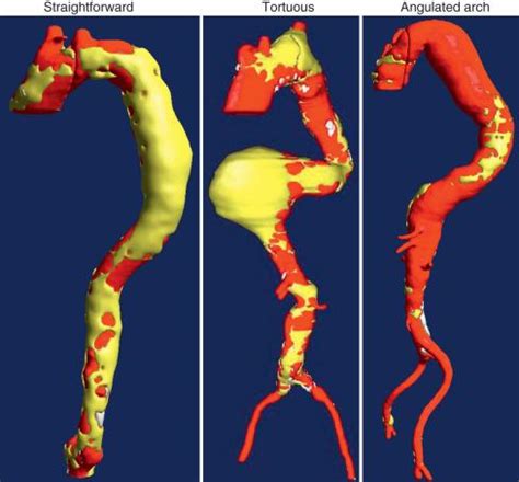Thoracic Endovascular Aortic Repair For Descending Thoracic Aortic And Aortic Arch Aneurysms