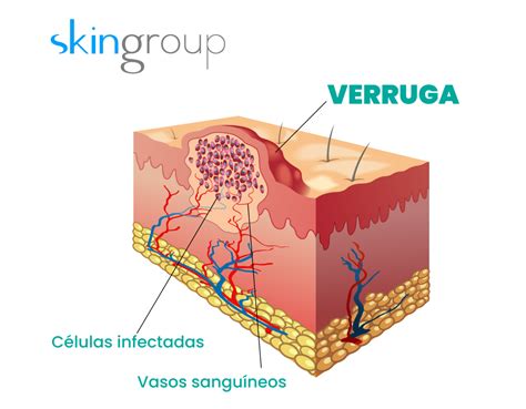 Verrugas Skingroup Las Águilas