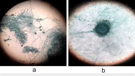 Microscopic Findings Direct Microscopic Examination Showing Septate