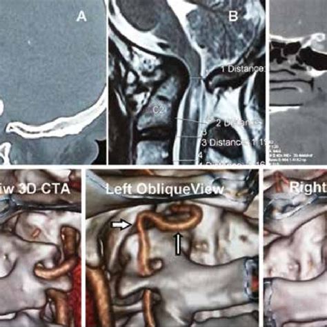 Comparison Of Normal Va Upside Down Va And Persistent First Download Scientific Diagram
