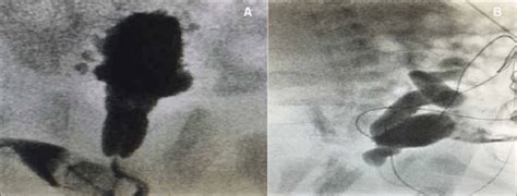Voiding Cystourethrogram A Preoperative Voiding Cystourethrogram