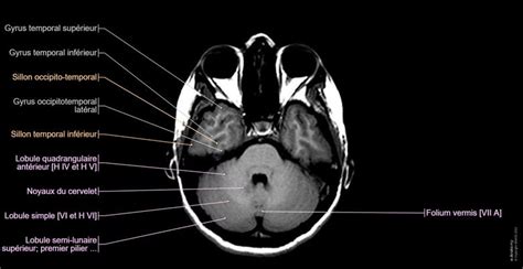 Cerveau Irm En Coupes Axiales Anatomie Normale E Anatomy