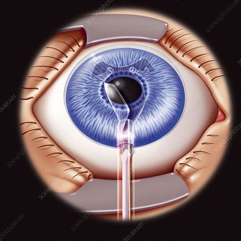 Intraocular Lens Stock Image C0027252 Science Photo Library